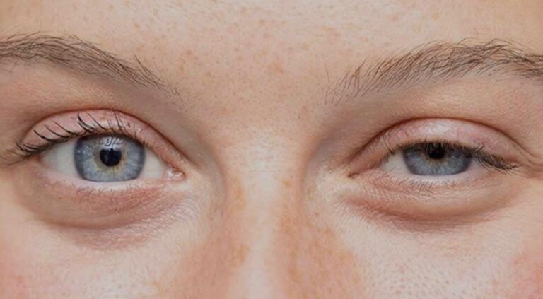Cirurgia de Ptose Palpebral - Dra. Maria Claudia Eichenberg